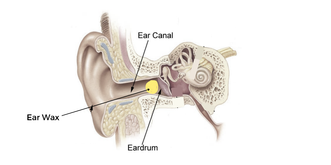Why is Wax Stuck in My Hearing Aid? Find out at Ear Cleaning Clinic