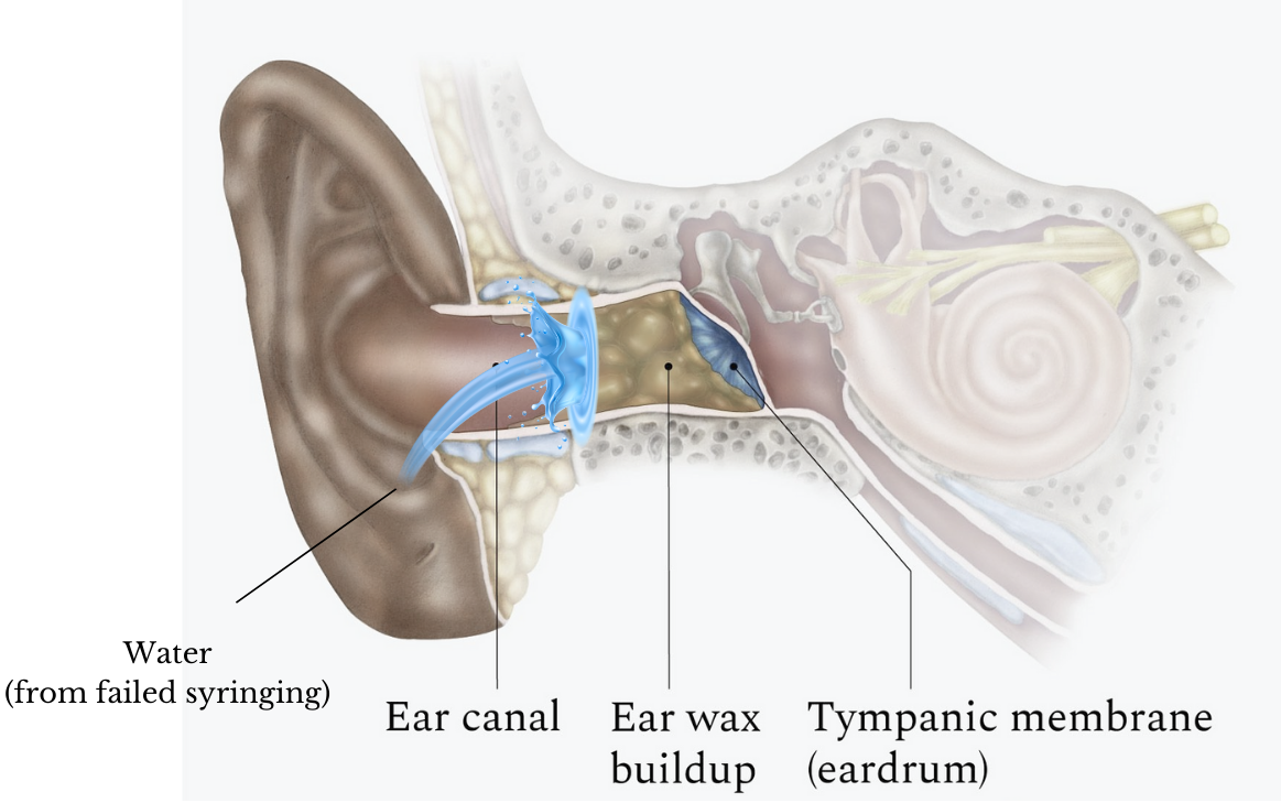 Why Microsuction Ear Wax Removal? - Ear Cleaning Clinic